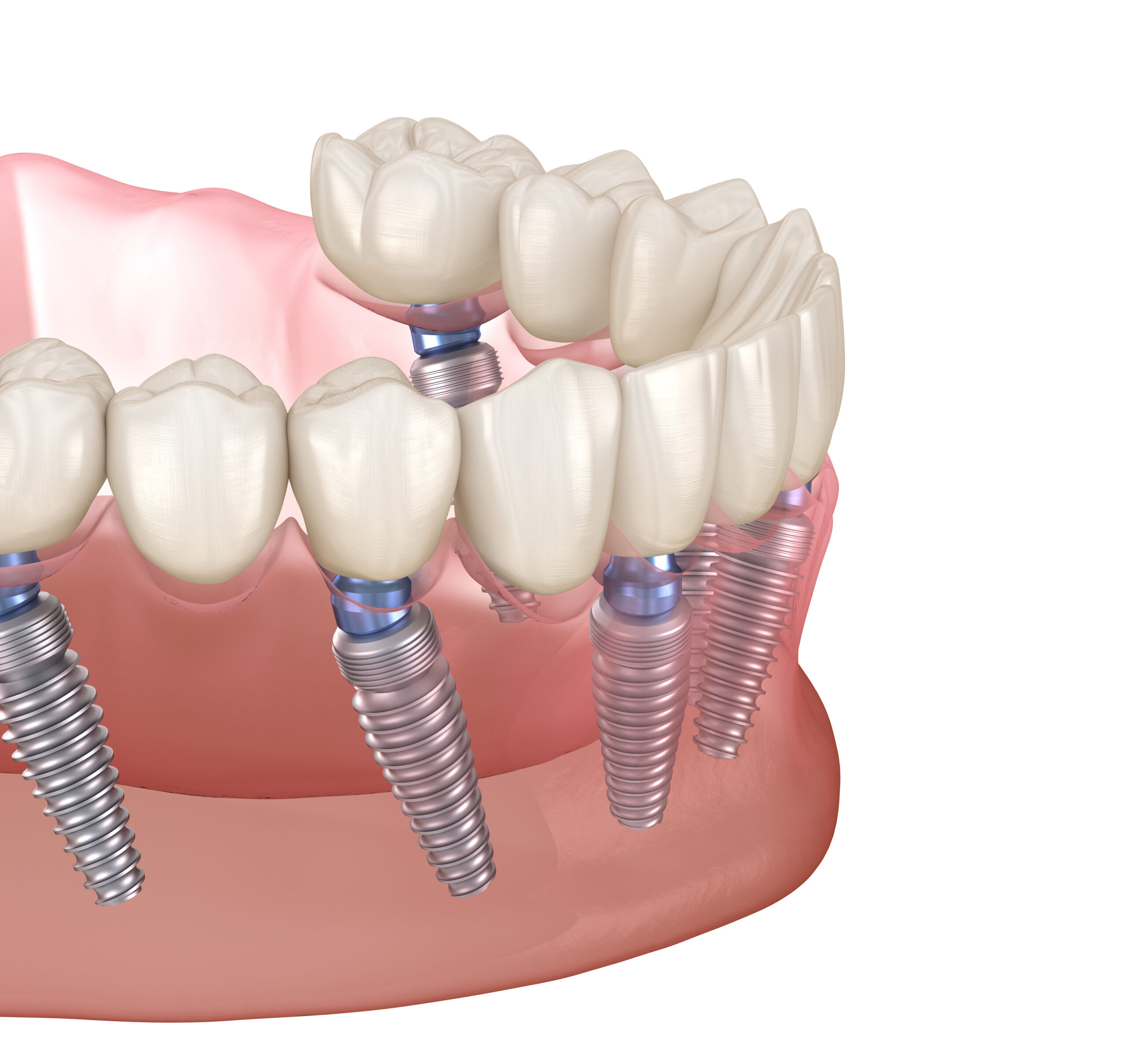 How Implants Secure Dentures - Shrewsbury Prosthodontic
