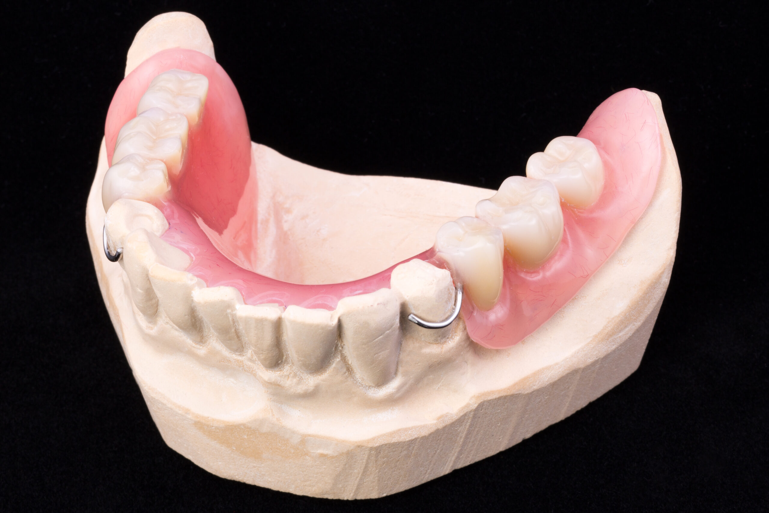 How We Secure Partial Dentures - Shrewsbury Prosthodontic